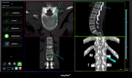 spine navigation - Medbionix